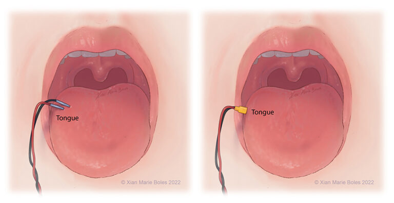 INTRAOPERATIVE NEUROMONITORING – Bi Lab